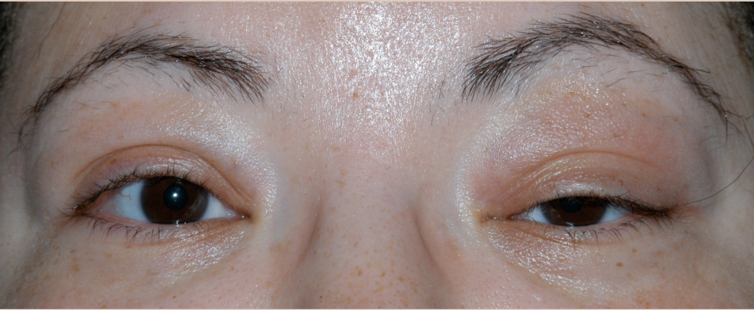 Sarcoidosis Affecting The Lacrimal Gland Sarcoidosis Affecting The Lacrimal Gland