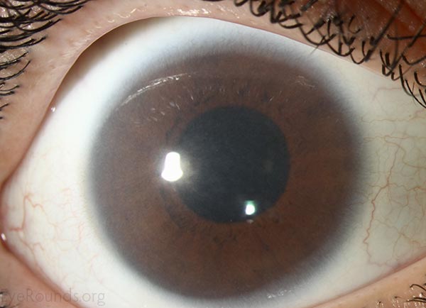 Corneal clouding in Hurler's syndrome