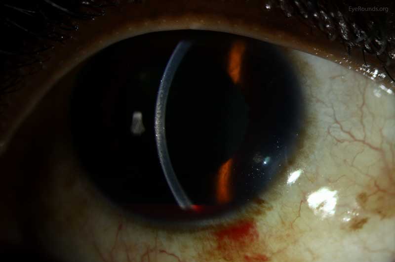 Traumatic hyphema