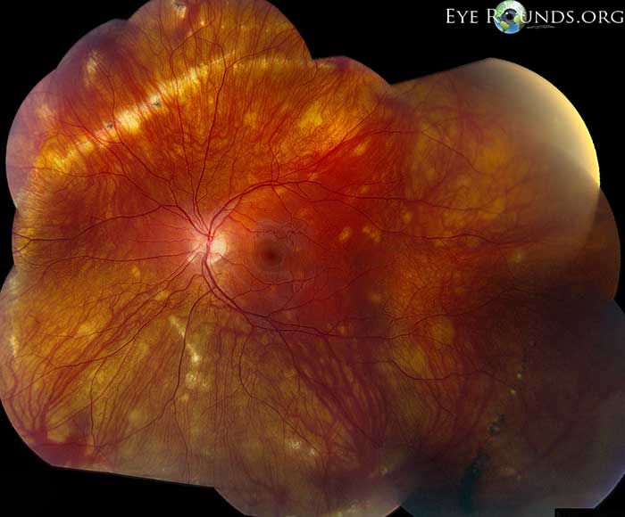 Multifocal choroiditis and panuveitis (MCP)