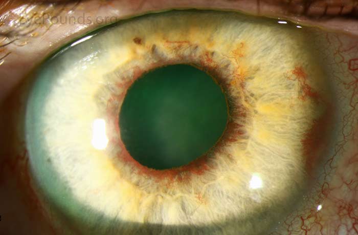 Rubeosis iridis or neovascularization of the iris in diabetes
