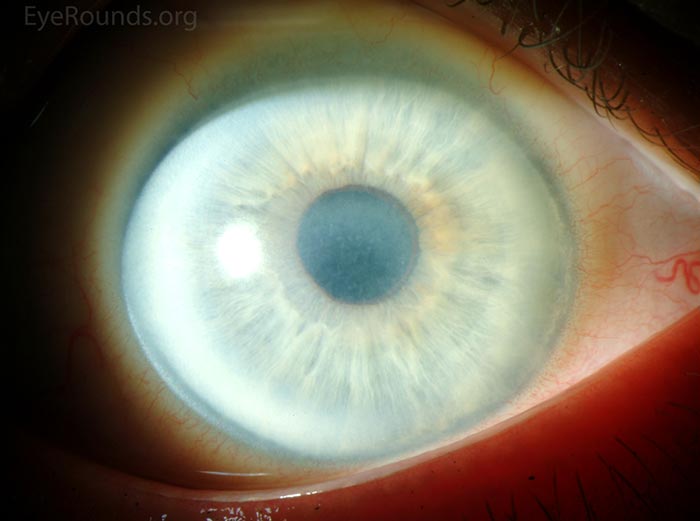 Schnyder Corneal Dystrophy