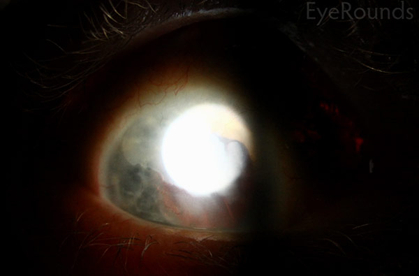 Scleromalacia with transillumination defect in the setting of chronic ...