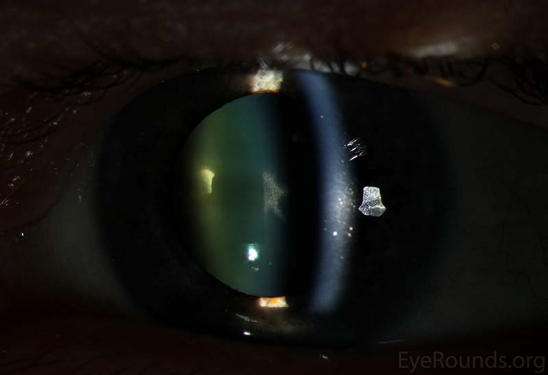 Chlorpromazine-induced cataract