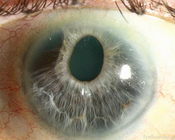 Essential iris atrophy, iridocorneal endothelial (ICE) syndrome