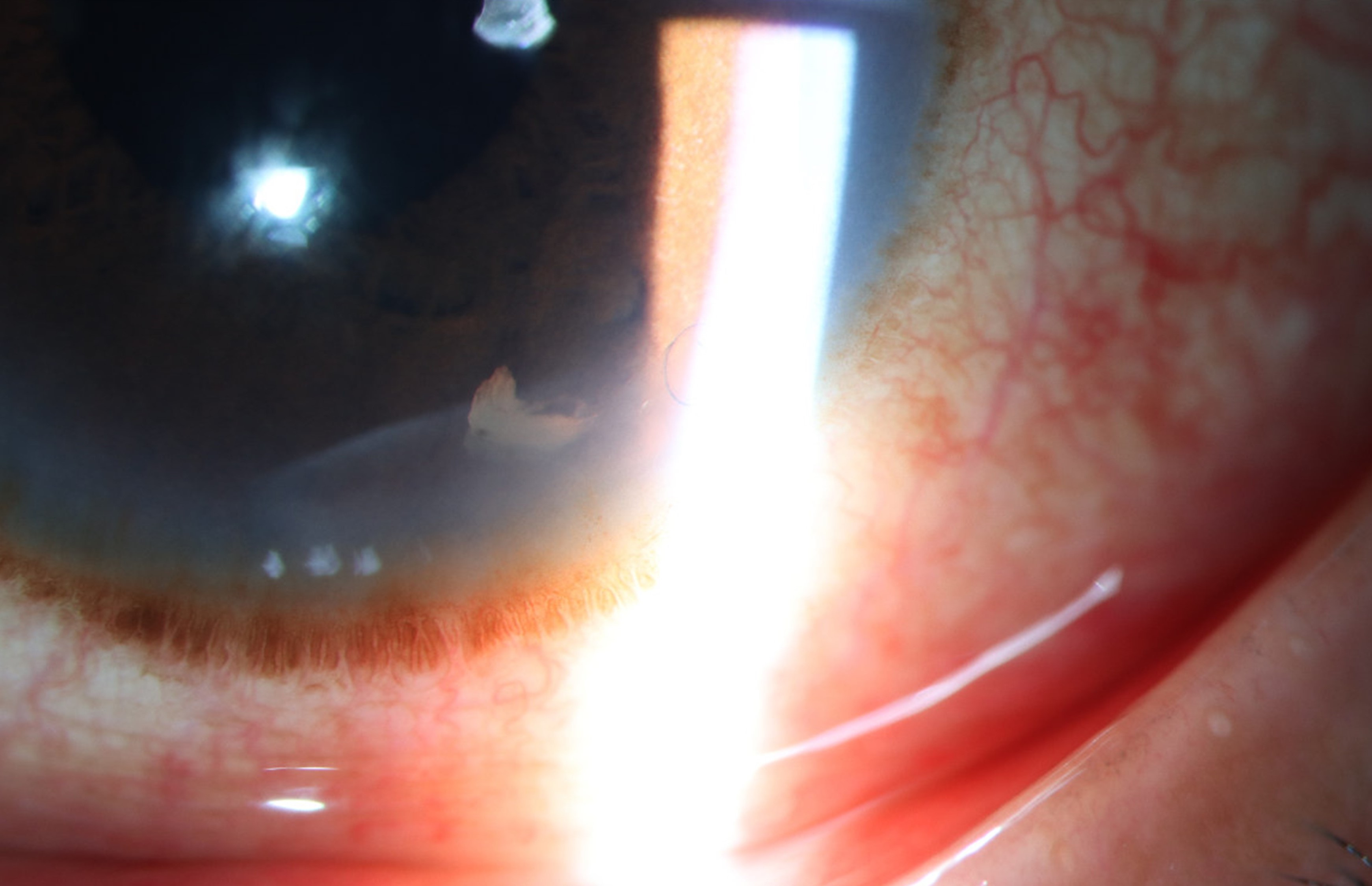 Retained Lens Fragment