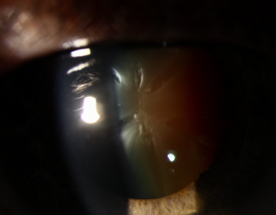 Atlas Entry - Brunescent cataract