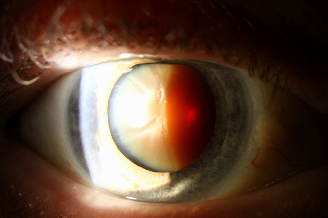 Atlas Entry - Brunescent cataract