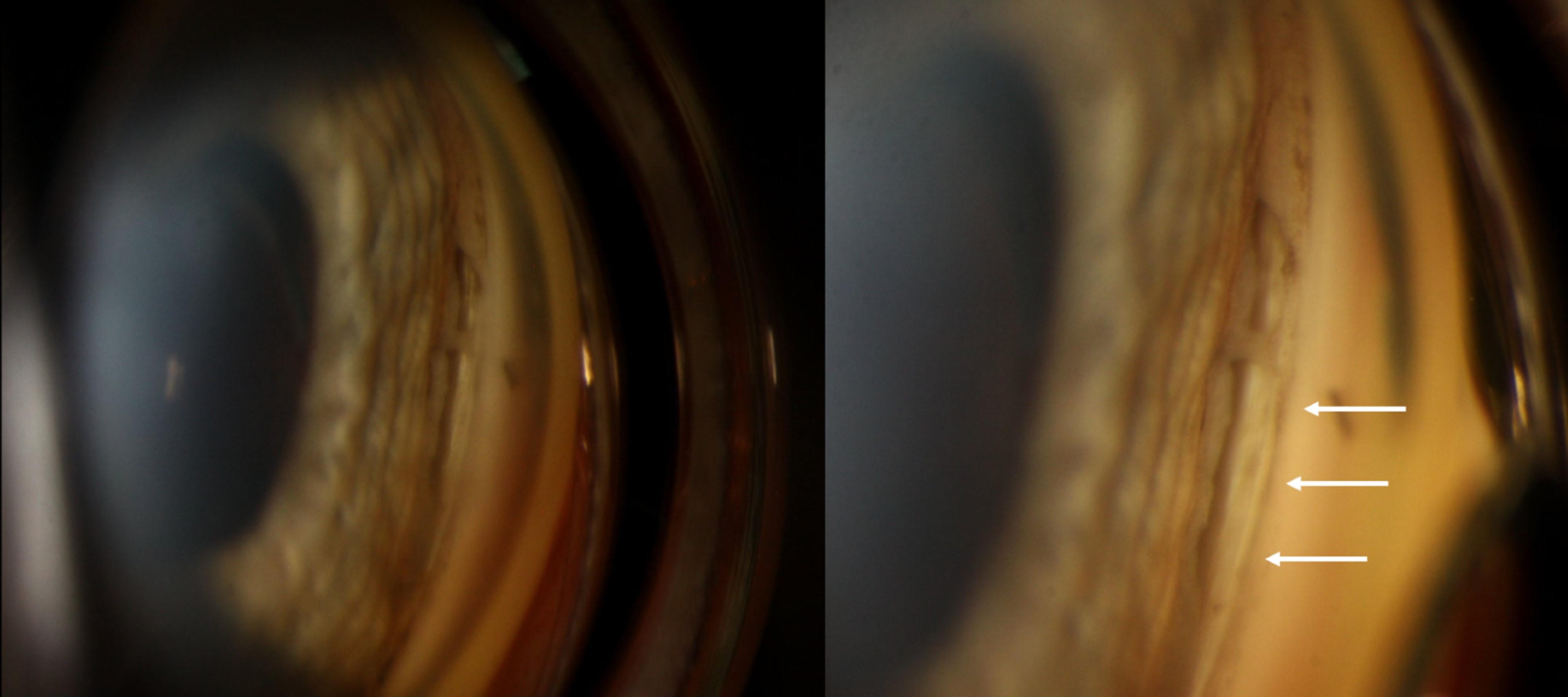 Atlas Entry - Angle recession and cyclodialysis after blunt trauma