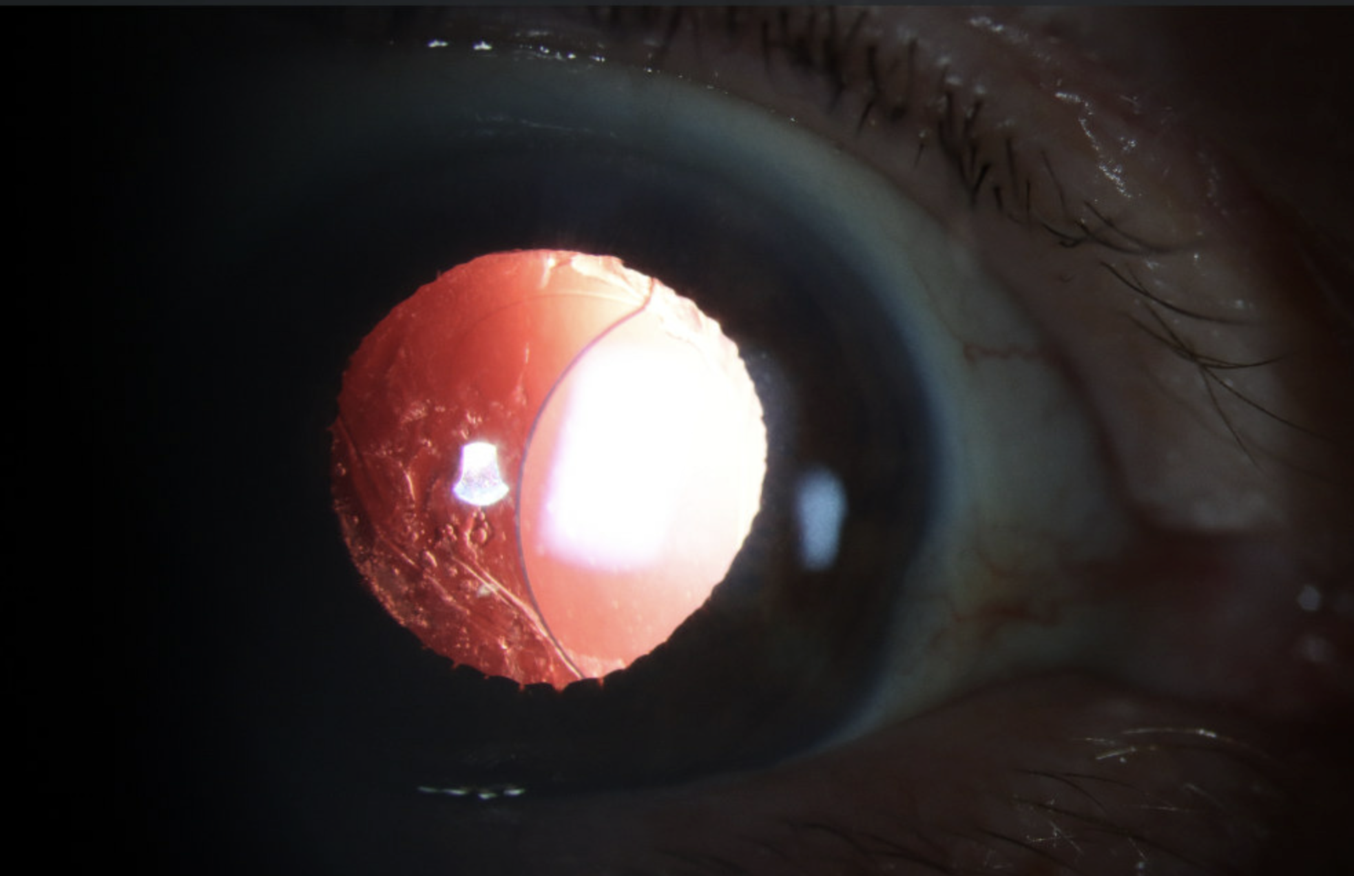 Subluxated posterior chamber intraocular lens implant
