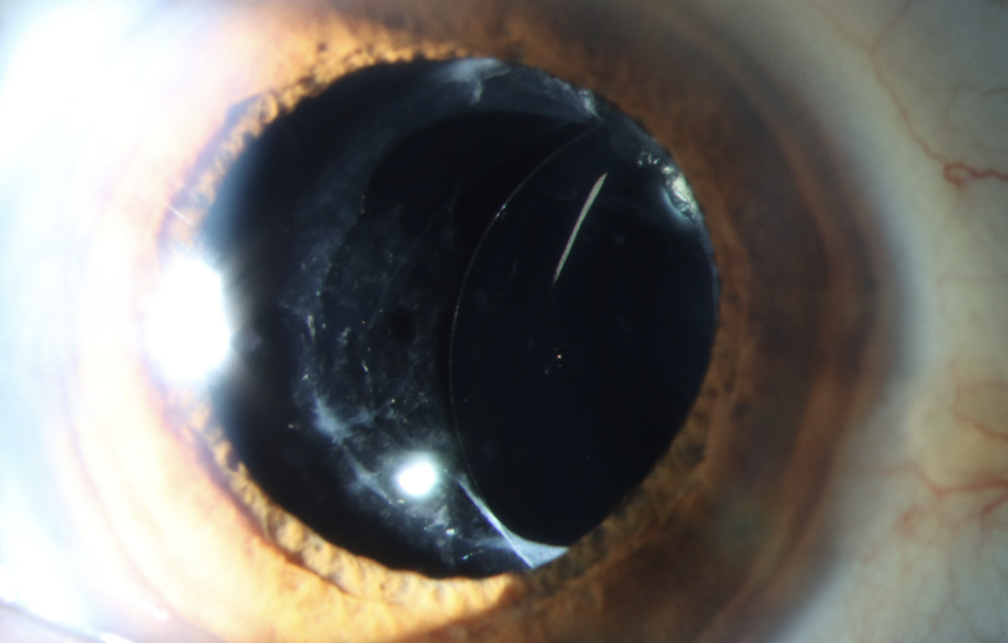 Subluxated posterior chamber intraocular lens implant