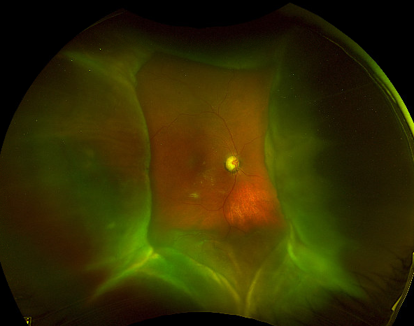 Atlas Entry - Choroidal effusion in posterior scleritis