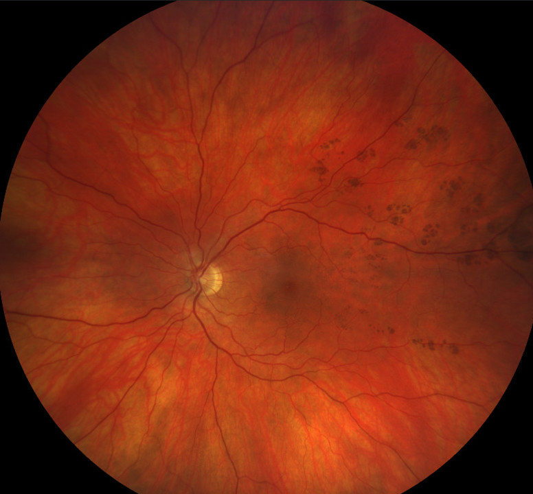 Atlas Entry - Congenital hypertrophy of the retinal pigmented ...