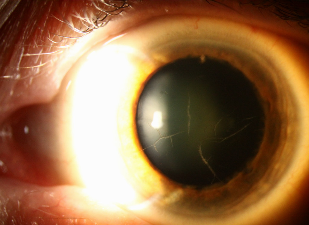 Atlas Entry - Lattice corneal dystrophy