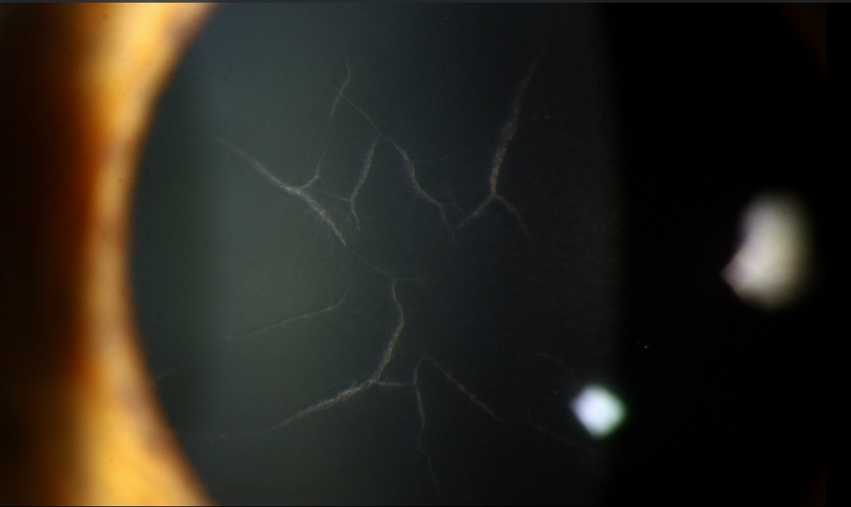 Atlas Entry - Lattice corneal dystrophy