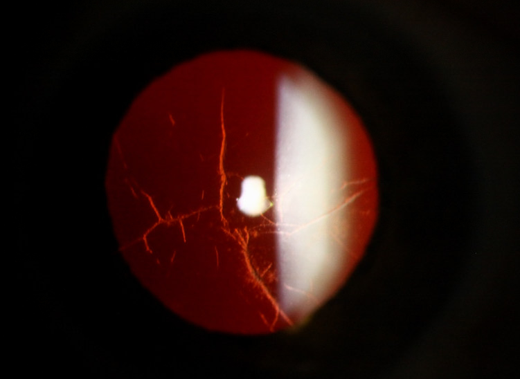 Atlas Entry - Lattice corneal dystrophy