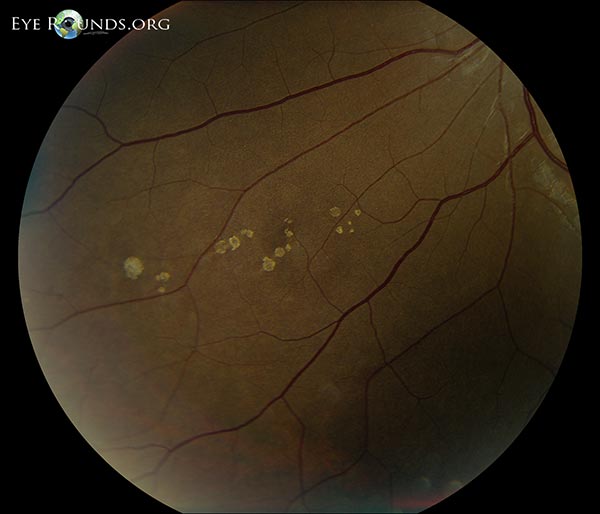 Grouped congenital albinotic spots of the retinal pigmented epithelium ...