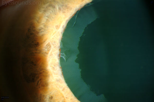 Pseudoexfoliation syndrome
