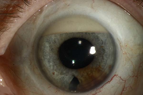 Reverse hypopyon formed by emulsified silicone oil in the anterior chamber