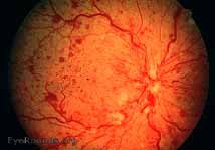 Central Retinal Vein Occlusion (CRVO). EyeRounds.org: Online Ophthalmic ...