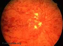 Central Retinal Vein Occlusion (CRVO). EyeRounds.org: Online Ophthalmic ...