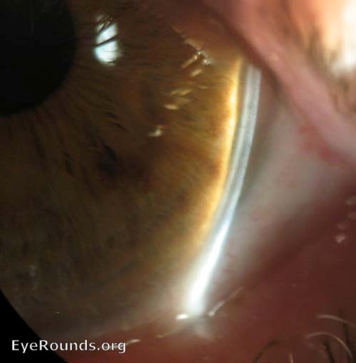 acute angle closure glaucoma. EyeRounds.org: Online Ophthalmic Atlas