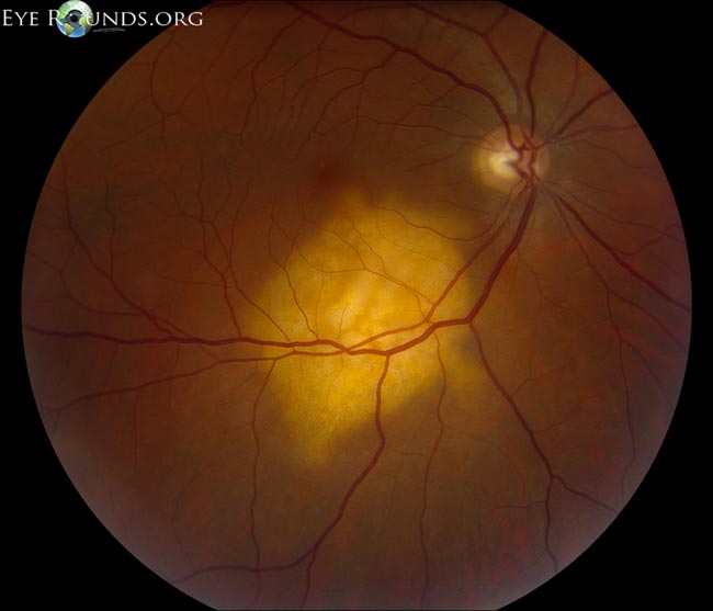 Carcinosarcoma choroidal metastasis