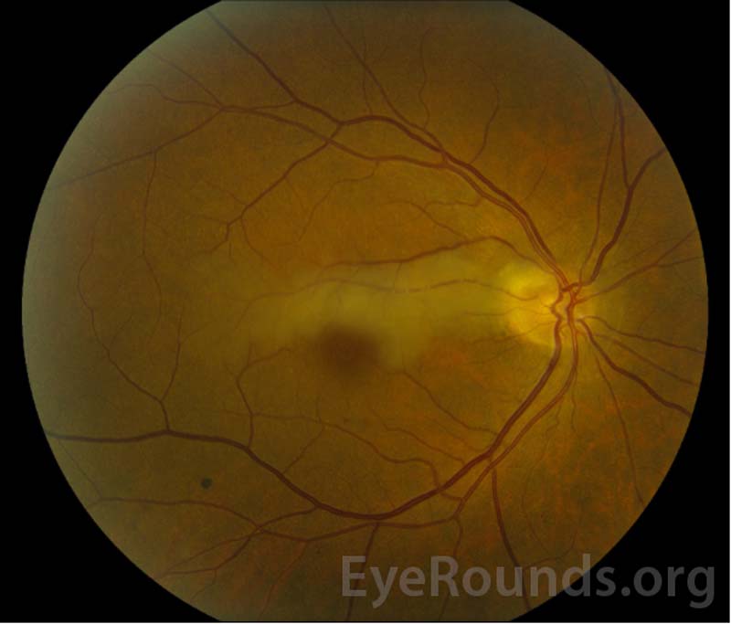Cilioretinal Artery Occlusion