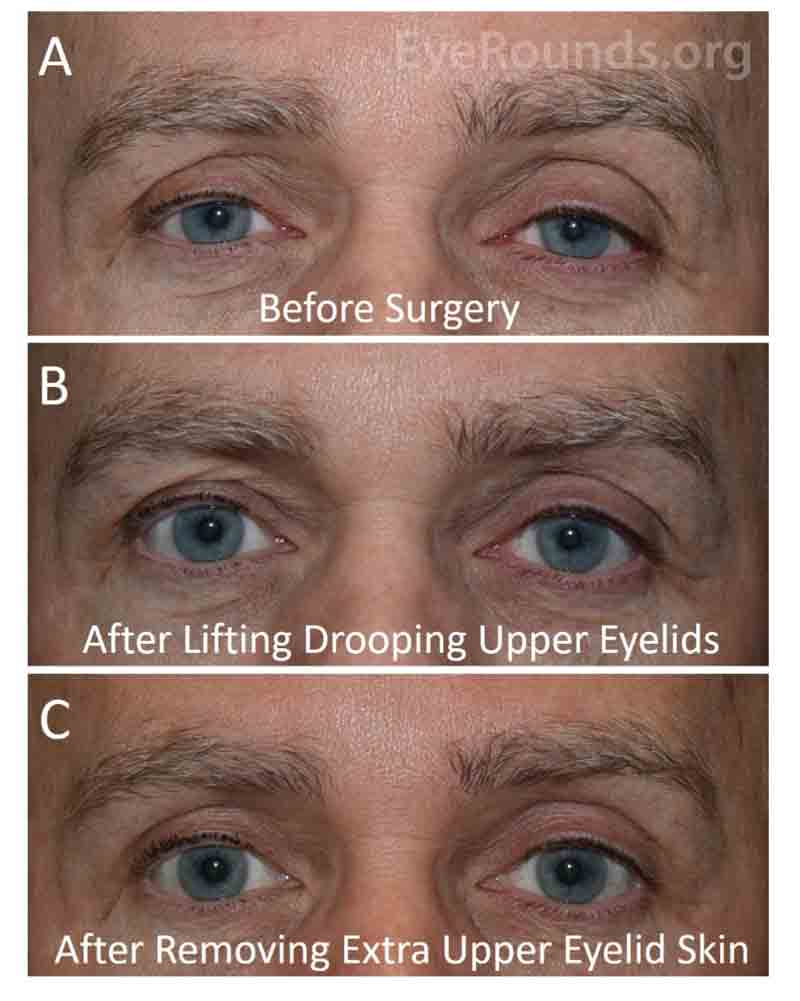 Cosmetic Correction of Secondary Upper Eyelid Dermatochalasis After ...