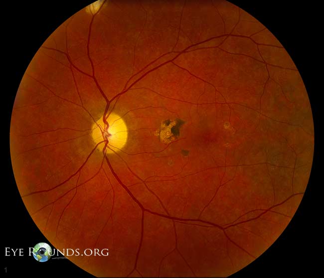 Atlas Entry Diffuse Unilateral Subacute Neuroretinitis DUSN Atlas Entry Diffuse Unilateral Subacute Neuroretinitis DUSN