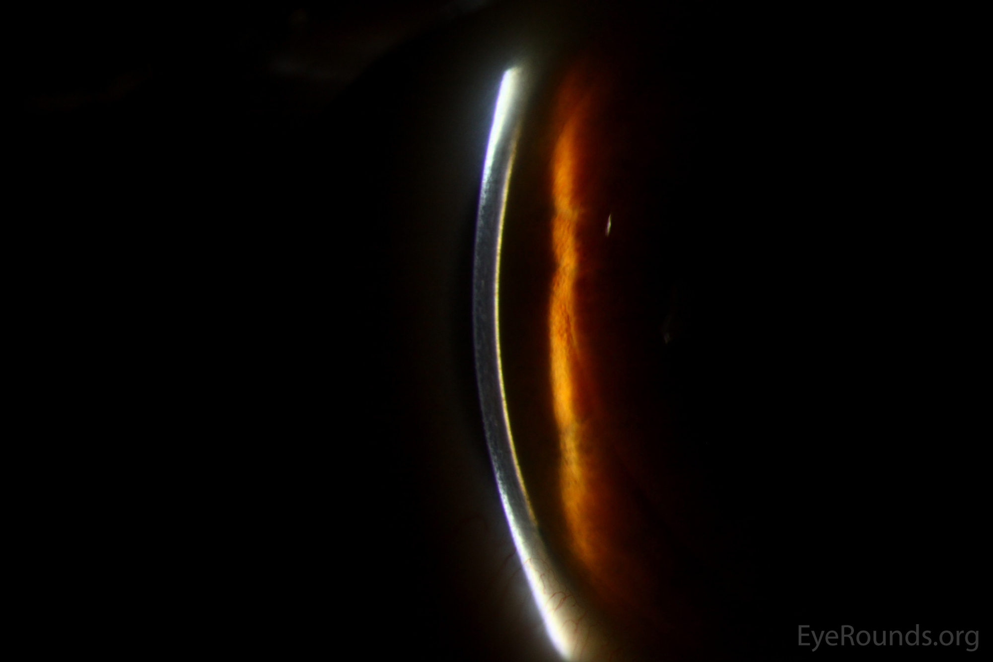 Atlas Entry - Kayser-Fleischer Ring in Wilson's Disease