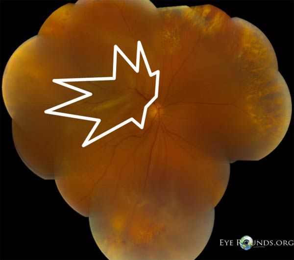 Retinal Breaks/Holes with Proliferative Vitreoretinopathy and Chronic ...
