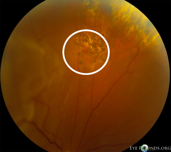 Retinal Breaks/Holes with Proliferative Vitreoretinopathy and Chronic ...