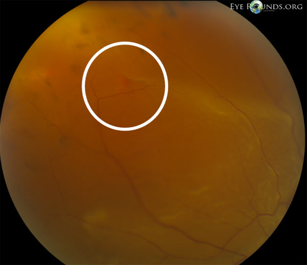 Retinal Breaks/Holes with Proliferative Vitreoretinopathy and Chronic ...