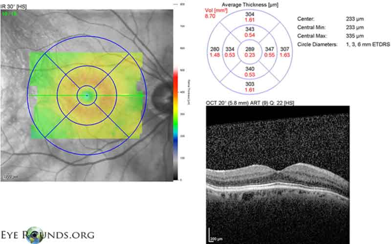 Rhegmatogenous Retinal Detachment, Macula-Off: The University of Iowa ...