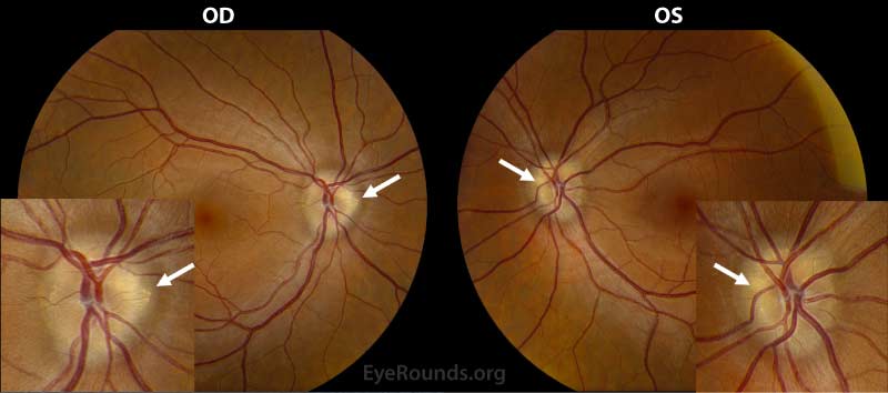 Optic Disc Drusen. EyeRounds.org: Online Ophthalmic Atlas