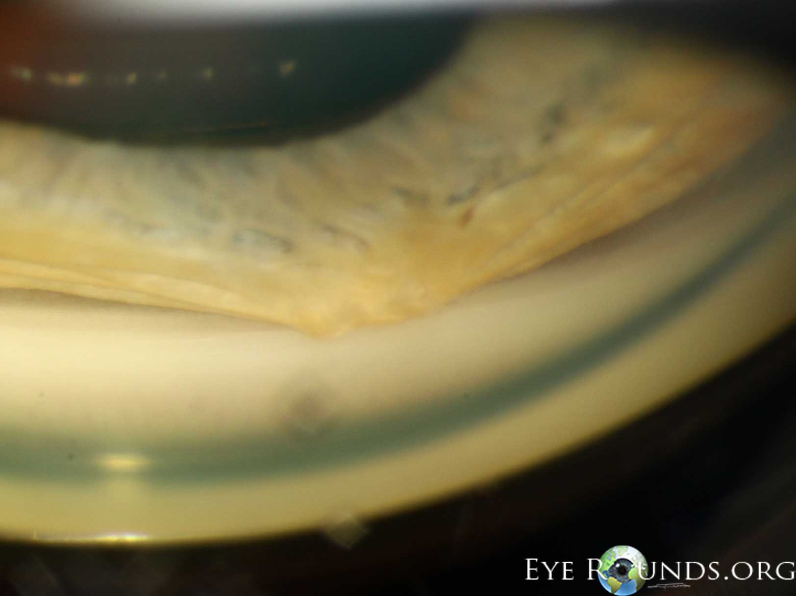 High peripheral anterior synechia in iridocorneal endothelial syndrome ...