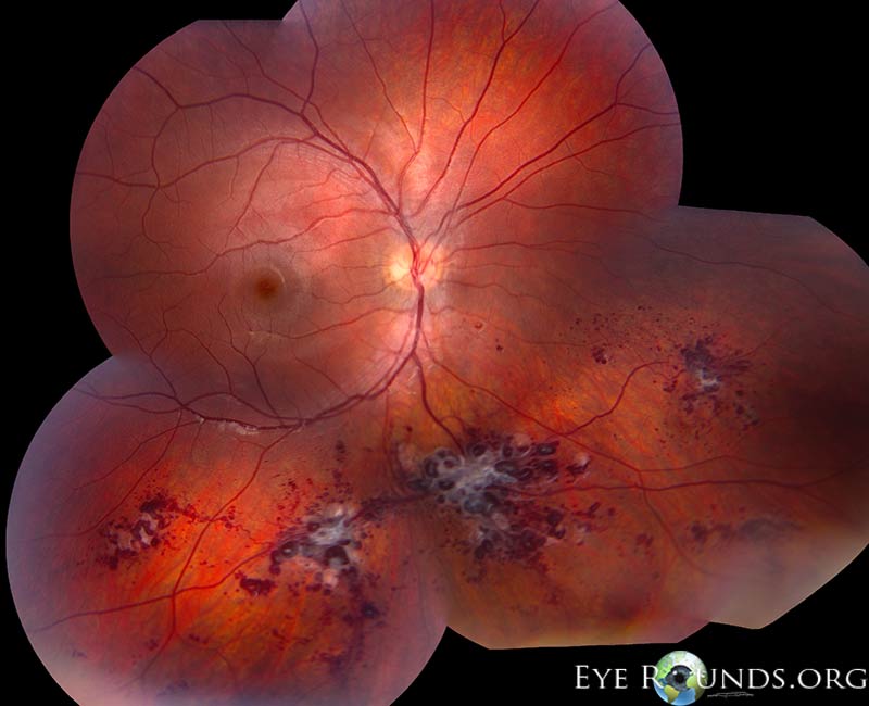 Retinal Cavernous Hemangiomas: The University of Iowa, Ophthalmology