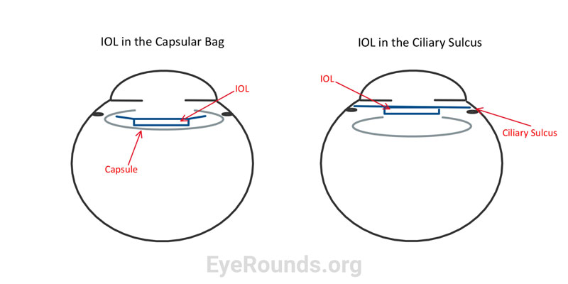 Capsular Block Syndrome