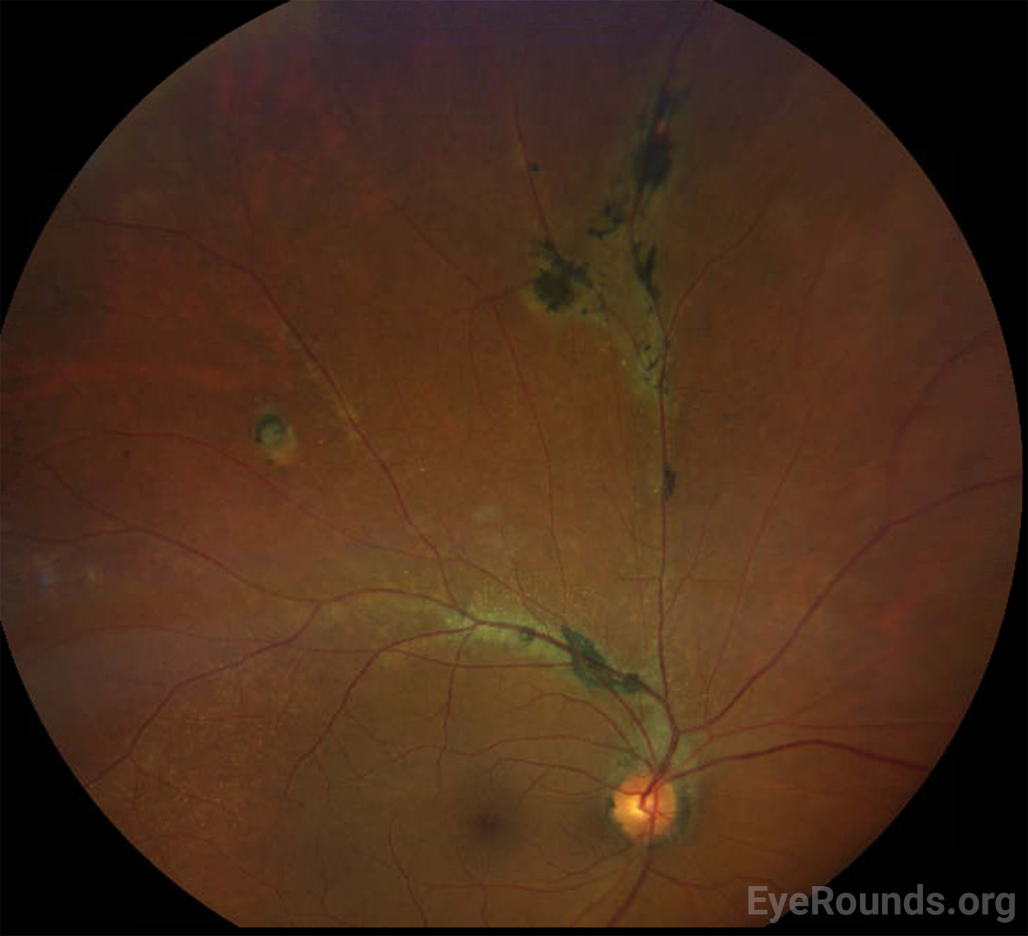 Pigmented Paravenous Retinochoroidal Atrophy