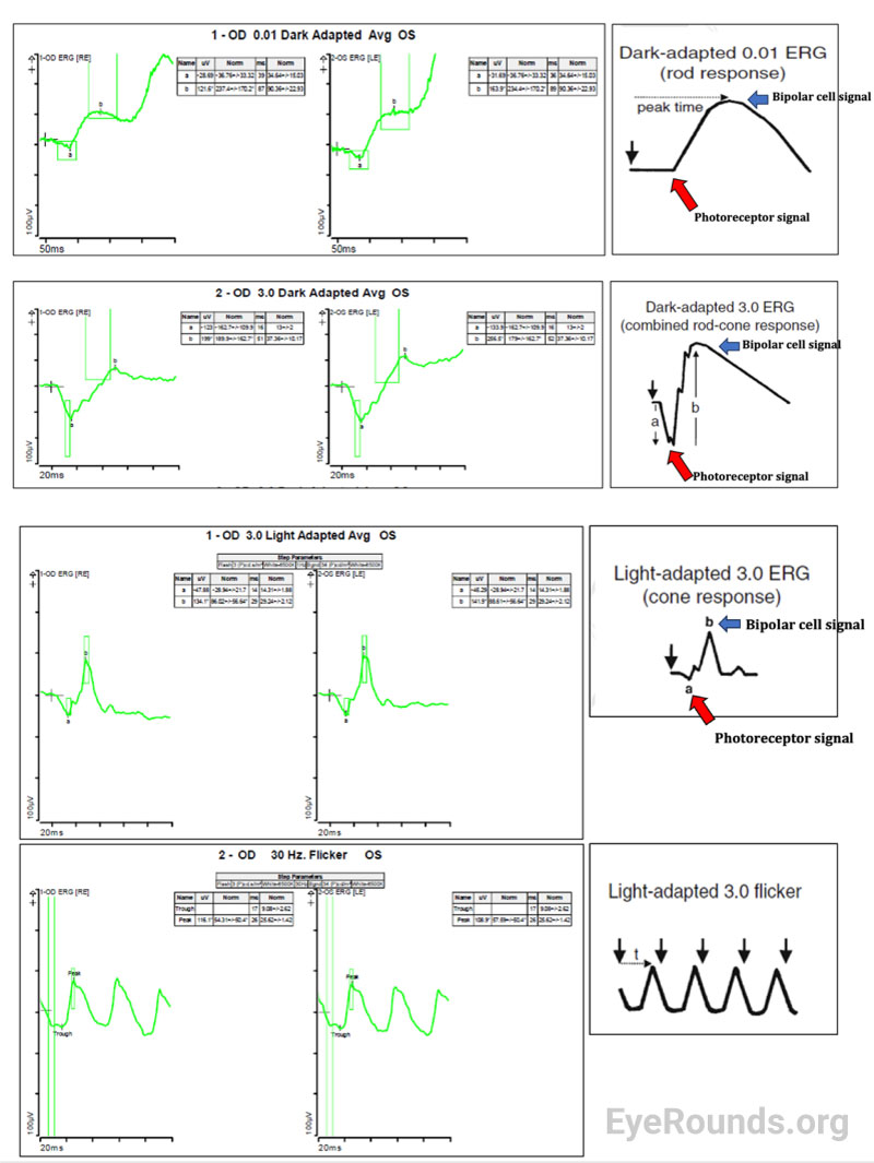 Diagnosis and management of Juvenile X-linked Retinoschisis (JXLR)