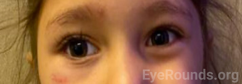 Juvenile ocular myasthenia gravis